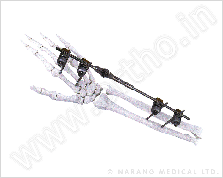 Hoffmann Type External Fixators - 5.0mm, Upper Limb, Hoffmann Type ...