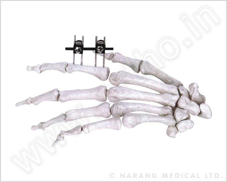 Hoffmann Type External Fixators - 5.0mm, Upper Limb, Hoffmann Type ...