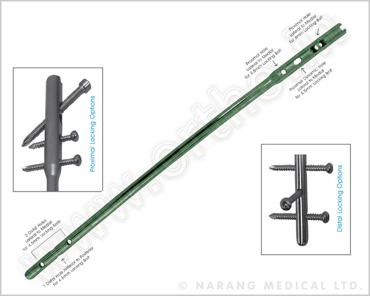 Multi-Fix Femoral Nail – Unreamed, Multi-Fix Femoral Nail – Unreamed ...